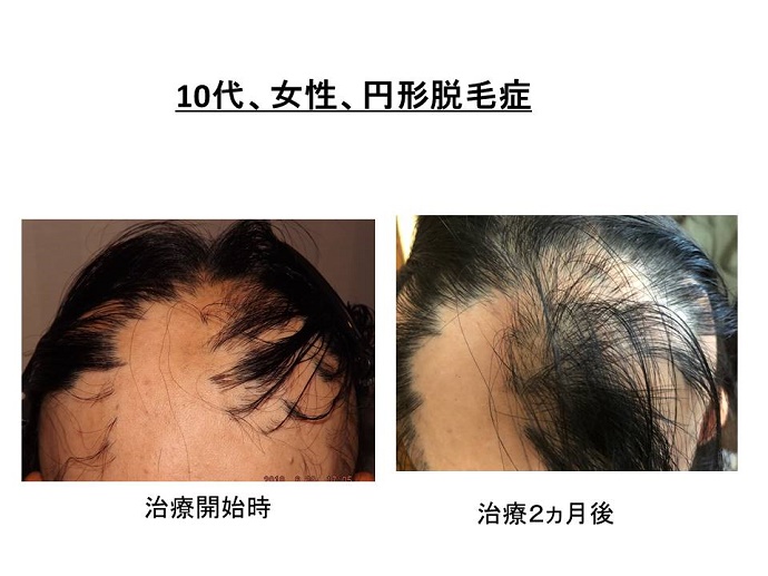 円形脱毛症の治療に、脱毛する薬を使用され、悪化した患者様で改善！ 患者様からの声・メディア掲載・クリニックからのお知らせ 名古屋kクリニック